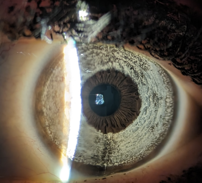 Iris et couleur des yeux - Docteur Damien Gatinel