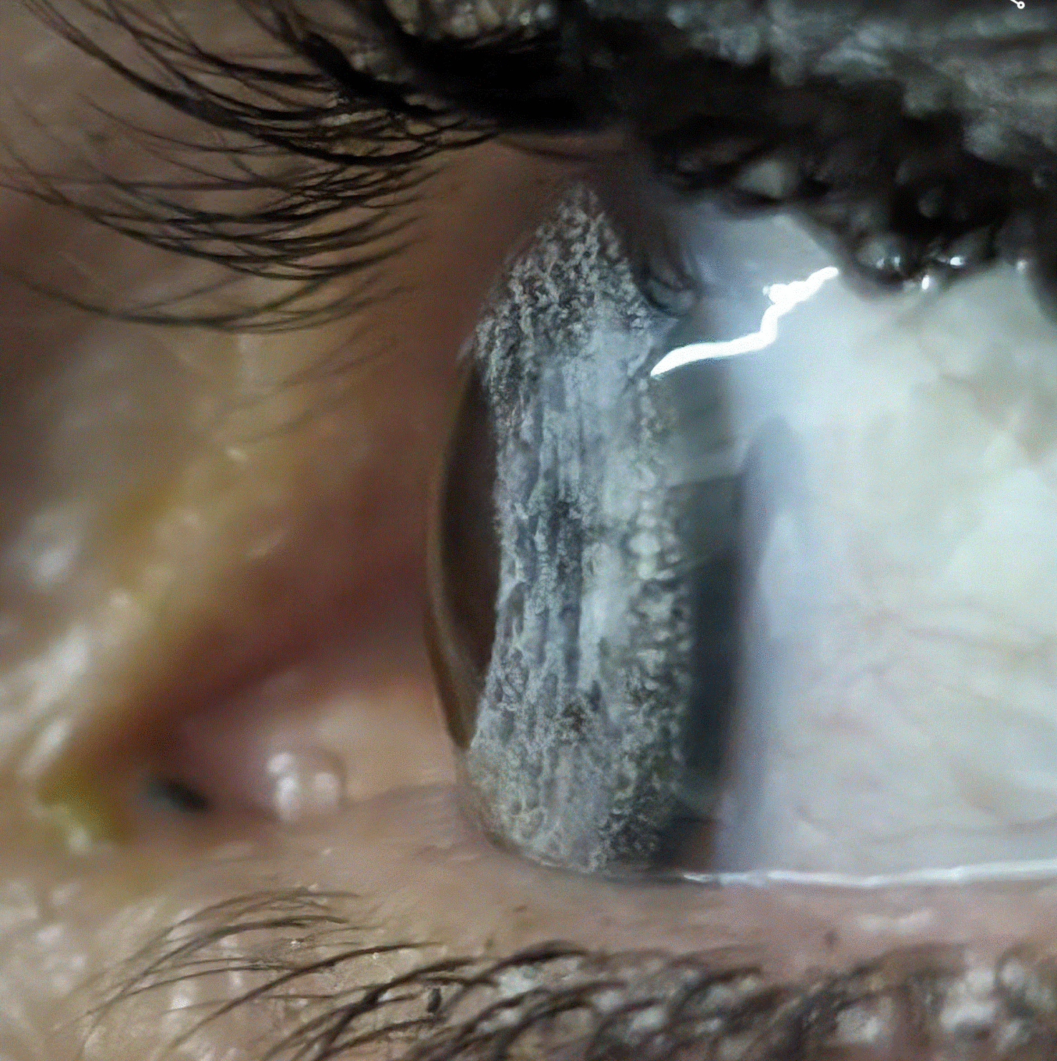 Iris et couleur des yeux - Docteur Damien Gatinel