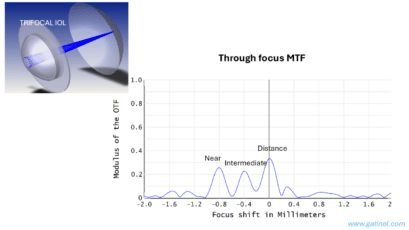 Trifocal IOL - Cataract implant - Docteur Damien Gatinel